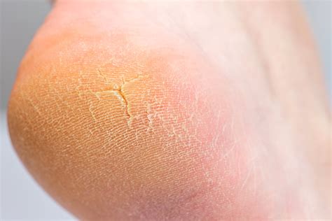 발 뒤꿈치에 균열의 가까이 건조한 피부와 균열이 있는 사람의 발뒤꿈치 가죽에 대한 스톡 사진 및 기타 이미지 가죽 갈색 개념 Istock