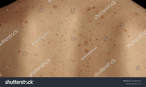 Skin Pigmentation Close Up Over 7335 Royalty Free Licensable Stock