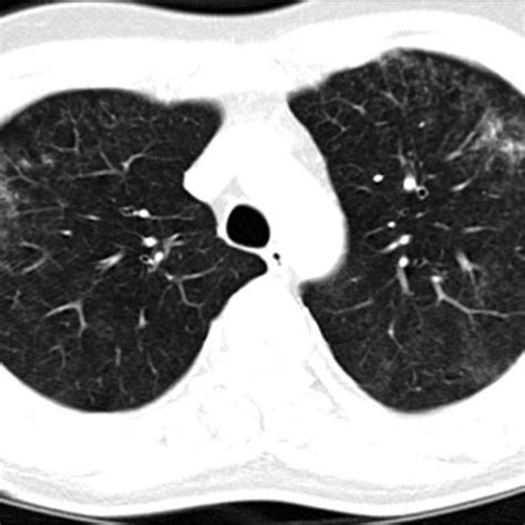 A Chest X Ray Some Reticulonodular Densities On Both Upper Lobes Download Scientific