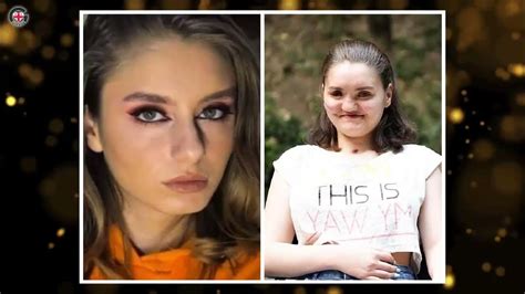 „ოპერაციამდე მითხრა უნდა დავშორდეთ“ გოგო რომლის ცხოვრებაც უბედურმა შემთხვევამ შეცვალა ️ Goga