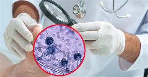 მიშვებული სოკოს მკურნალობა ძალიან მარტივია სახლში ჩაიტარეთ ეს პროცედურა დღეში 2 ჯერ