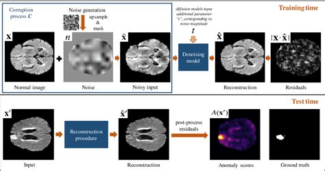 The Role Of Noise In Denoising Models For Anomaly Detection In Medical Images