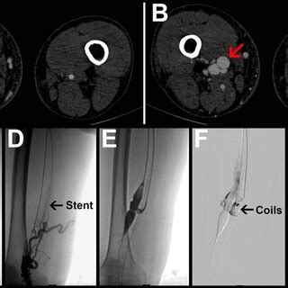 Representative Images For Case 1 A Preoperative CTA Image With The Download Scientific