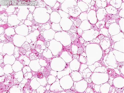 Hibernoma Microscopic Features