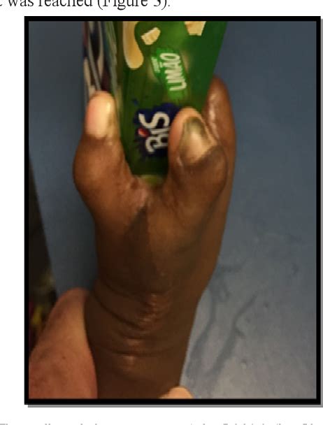 Figure 3 From Use Of Reverse Second Dorsal Metacarpal Artery Flap For The Treatment Of