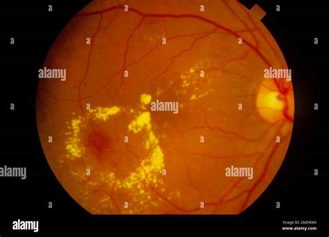 Diabetic Retinopathy Fundus Camera Image Of The Retina Of A Human Eye