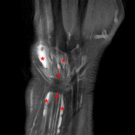 Stenosing Tenosynovitis Of The 4th Extensor Compartment Radsource