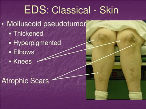 Ppt Ehlers Danlos Syndrome Recognition Diagnosis And Management