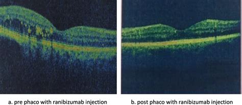Intravitreal Ranibizumab Injection A Preoperative B After 1 Month Download Scientific Diagram