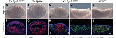 Figure 1 From Fgfr2 Mutation In 46 Xy Sex Reversal With