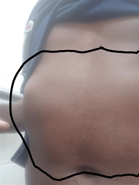 Chronic Constipation And Upper Abdominal Distention What Is The