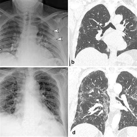 A Cxr In Antero Posterior View Shows Bilateral Reticular Pattern With Download Scientific