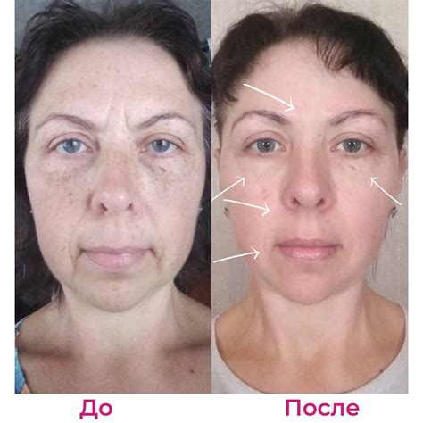 Тейпирование Лица Отзывы До И После Фото — Фото Картинки