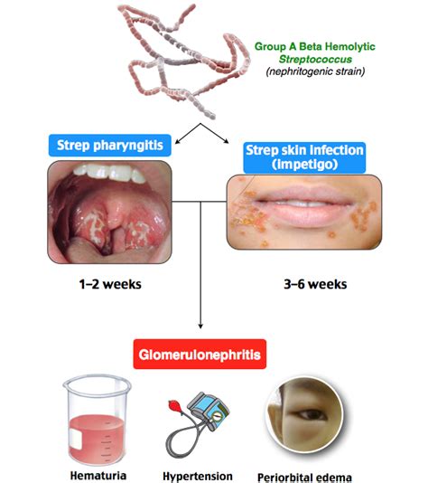 Acute Post Streptococcal Glomerulonephritis Medical Junction