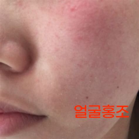 얼굴홍조크림 이게 제일 좋았음 네이버 블로그