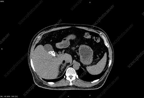 Gall Stone Ct Scan Stock Image F0427353 Science Photo Library