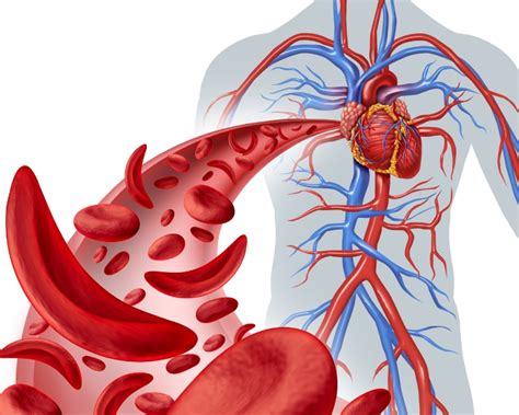 School Of Nursing Faculty Continue Fight Against Sickle Cell Disease