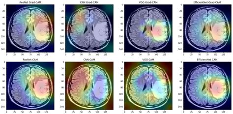 Saliency Map And Deep Learning In Binary Classification Of Brain Tumours