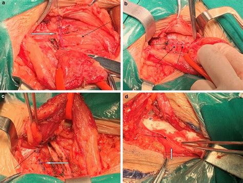 A Suture With Prolene Started From Pubic Tubercle White Arrow First Download Scientific