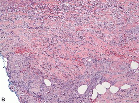 Pyoderma Gangrenosum Basicmedical Key