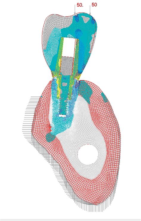 Finite Element Analysis Of The Implant Placed Download Scientific Diagram