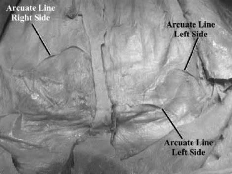 Type Ii Arcuate Line Right Side In Which The Fibers Of The Posterior Download Scientific