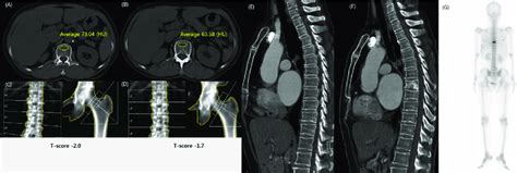 Compression Fracture In T8 Vertebral Body In A 61 Year Old Woman With Download Scientific