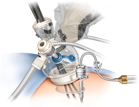 Single Port Robot Assisted Radical Prostatectomy Transperitoneal