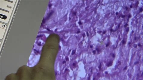 Liposarcoma Mixoide Youtube