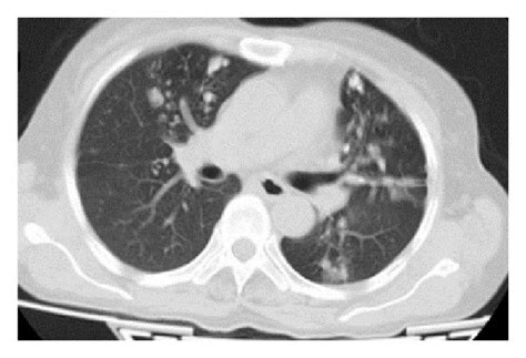 Multiple Irregular Opacities In Apical Segments Of Right Upper Lobe And Download Scientific