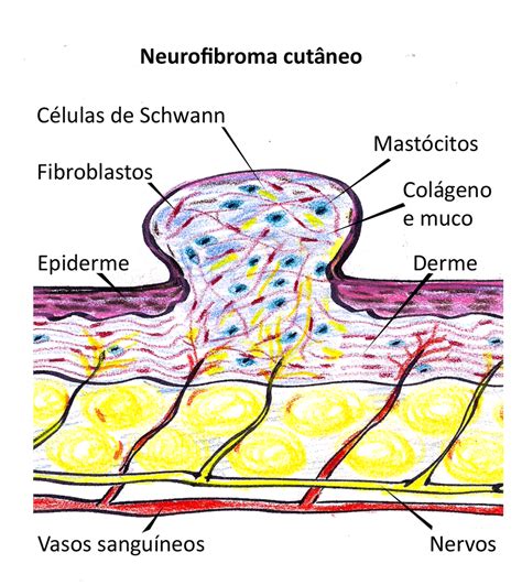 Parte 1 O Que São Os Neurofibromas Cutâneos Amanf
