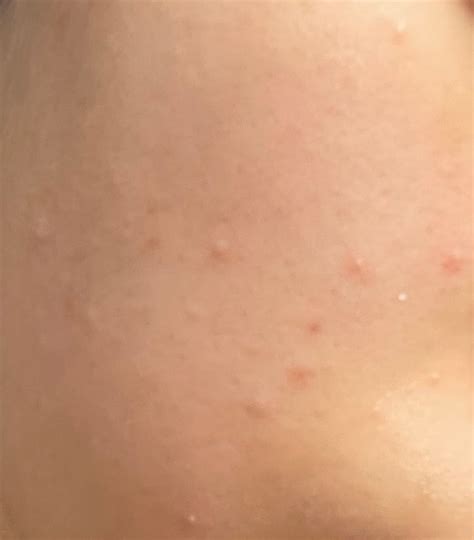 10대 여드름 어떻게 해야하나요 지식in