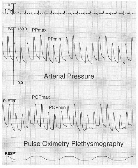 Respiratory Rate And Flow Waveform Estimation From Tri Axial Accelerometer Data At Margaret