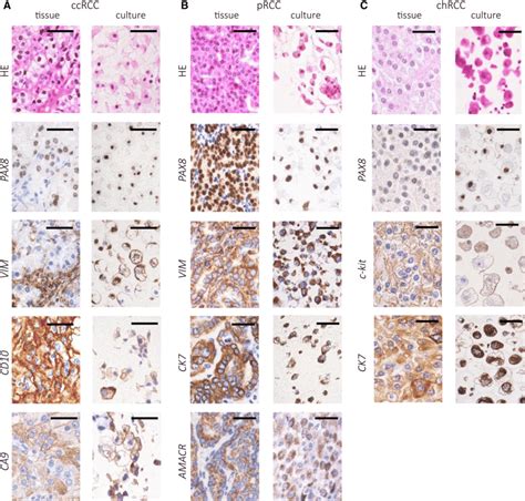 Ihc Staining Of Rcc Tissue And Derived Primary Cell Cultures The Cells