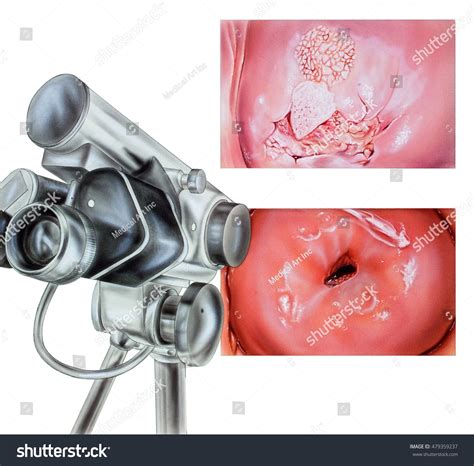 Normal Vs Abnormal Cervix
