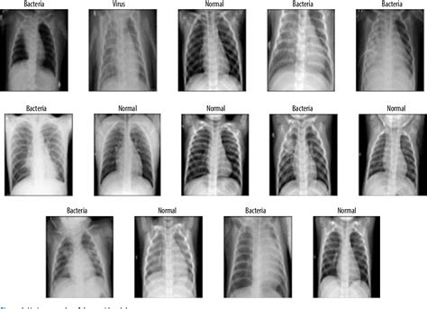 Figure 2 From An Improvement Of The Cnn Xgboost Model For Pneumonia Disease Classification