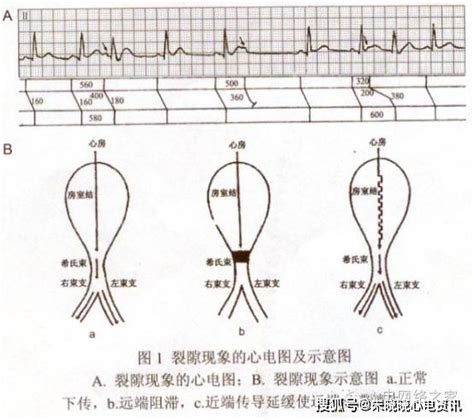 裂隙现象 解释 传导