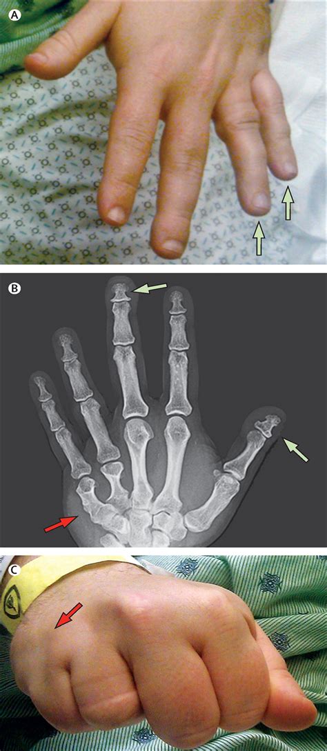 Pseudopseudohypoparathyroidism The Lancet