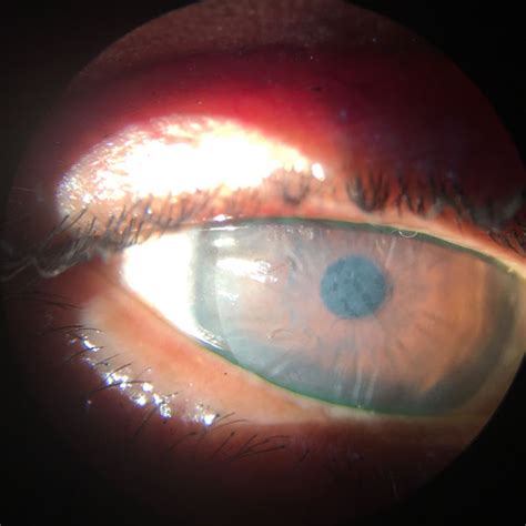 Epithelial Keratitis Ophthalogix