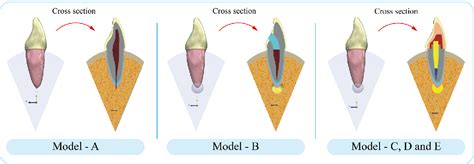 Figure 1 From Evaluation Of Stress Distribution On An Endodontically Treated Maxillary Central