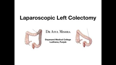 𝐋𝐚𝐩𝐚𝐫𝐨𝐬𝐜𝐨𝐩𝐢𝐜 𝐥𝐞𝐟𝐭 𝐜𝐨𝐥𝐞𝐜𝐭𝐨𝐦𝐲 𝐃𝐫 𝐀𝐭𝐮𝐥 𝐌𝐢𝐬𝐡𝐫𝐚 𝐋𝐮𝐝𝐡𝐢𝐚𝐧𝐚 Youtube