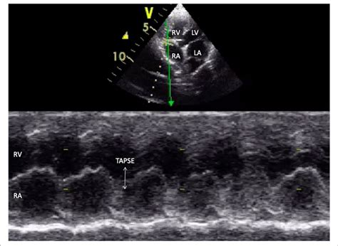 M Mode Echocardiographic Image Of Tricuspid Annular Plane Systolic