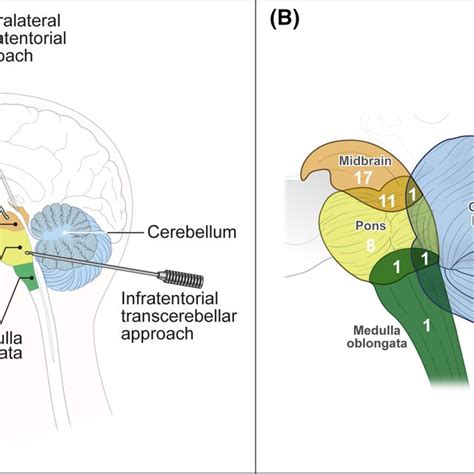 Histopathological Diagnoses Of Brainstem Lesions Astrocytic Tumors Download Scientific Diagram