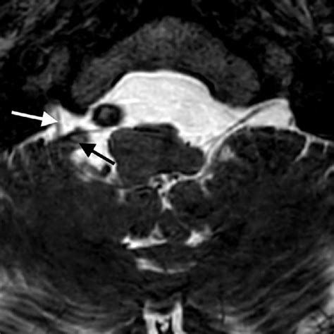 Axial Ciss 3d Sequence At The Level Of Medulla The Dilated Right