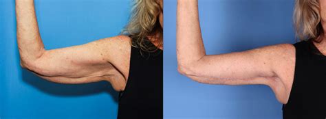 How Is An Arm Lift Done At Rae Johnson Blog