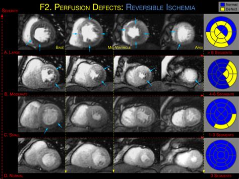 Myocardial Perfusion Cardiac Mri