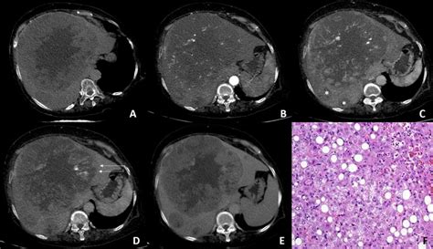 A 58 Year Old Female Patient With Non Cirrhotic Background Liver