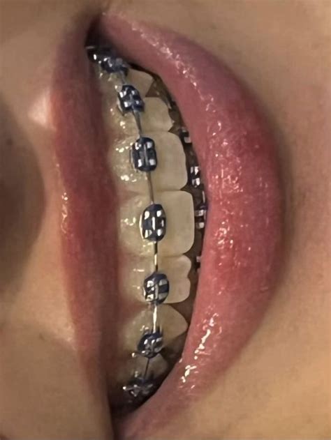 Braces Braces Colors Getting Braces Perfect Teeth