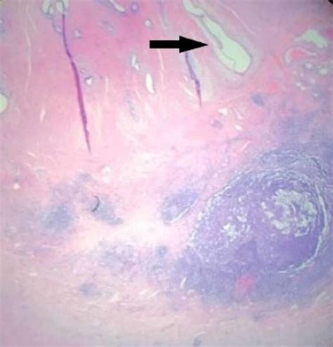 Appendix Arrow Depicts The Endometrial Glands And Stroma And Inflamed Download Scientific