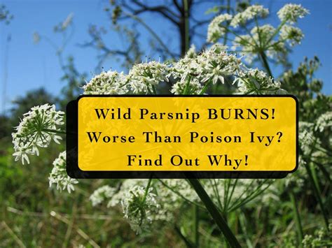 Wild Parsnip Burns Worse Than Poison Ivy Hg Wild Parsnip Burns Wild Parsnip Parsnips